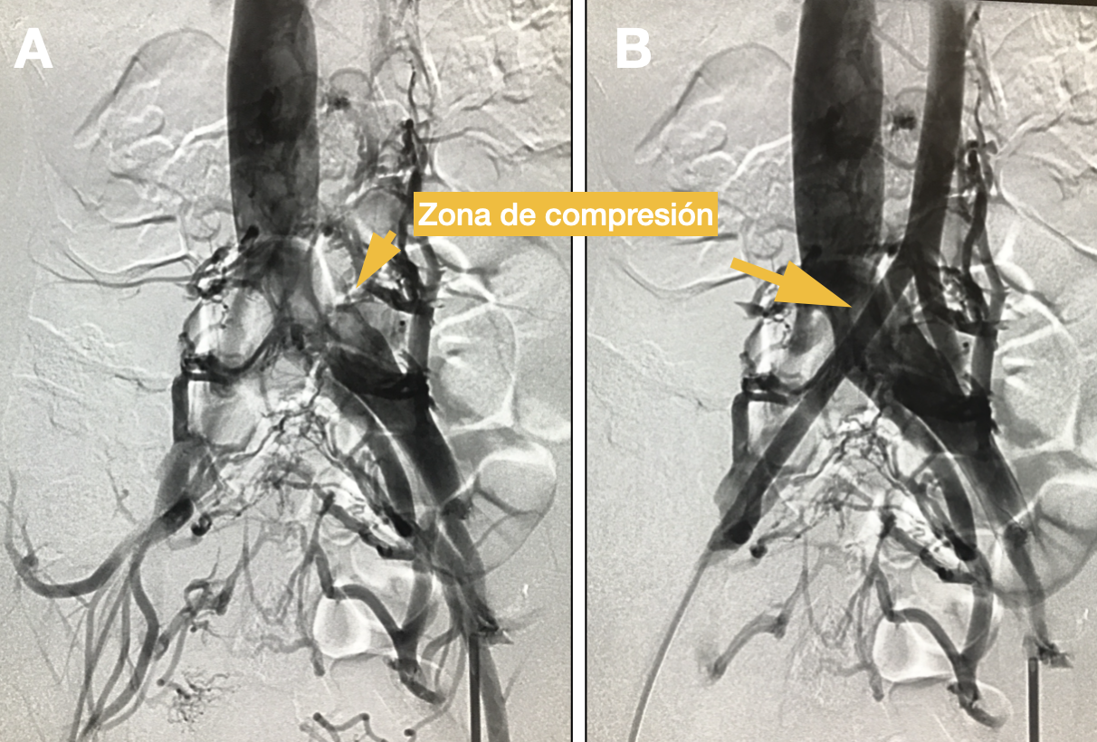 ¿Las varices pélvicas se relacionan siempre con los embarazos ...