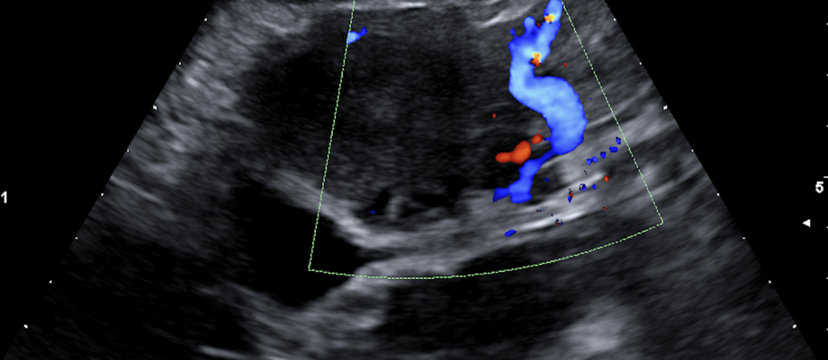 ¿Las varices pélvicas se relacionan siempre con los embarazos ...