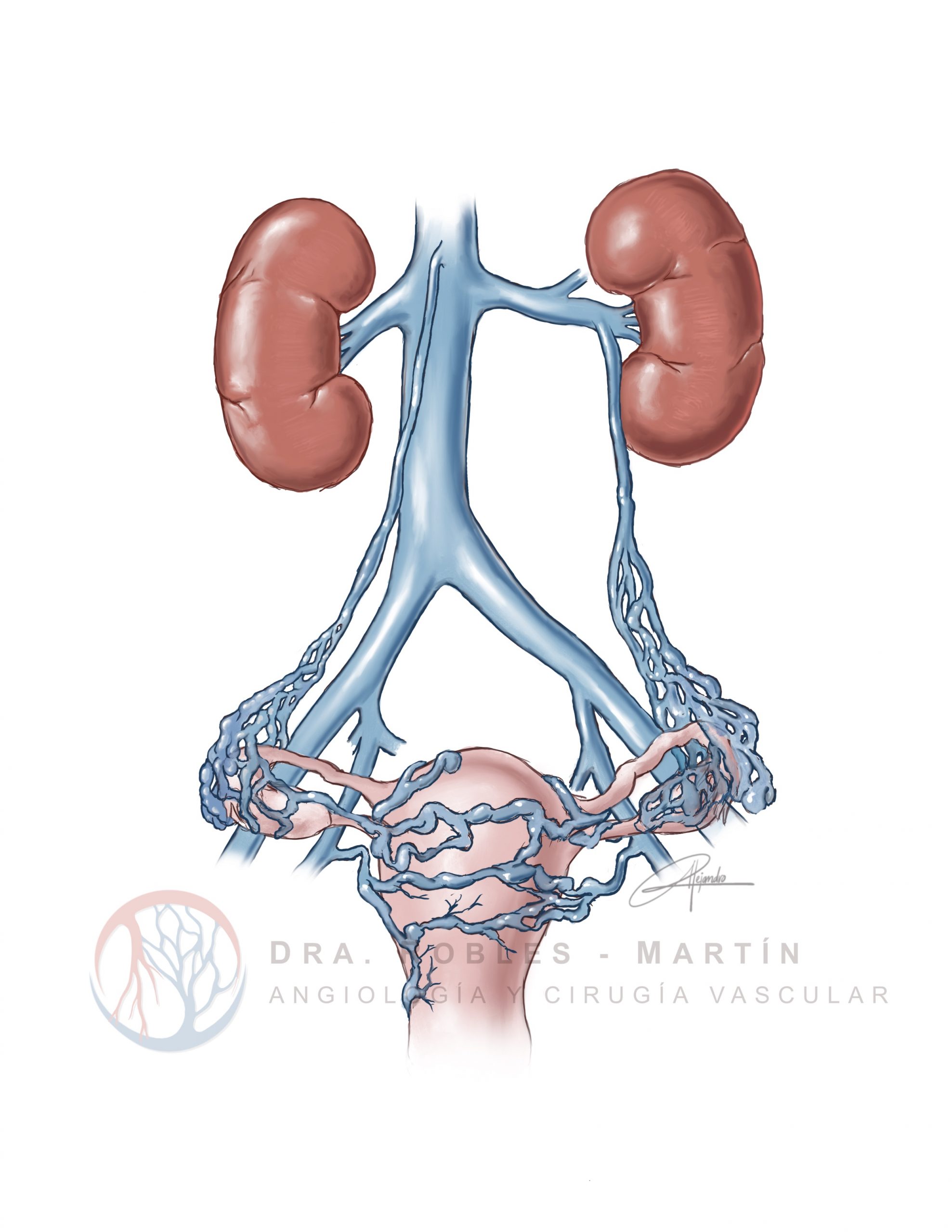 ¿Qué es la embolización de varices pélvicas? - Doctora María Luisa ...